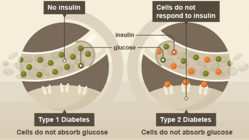 Type 1 Diabetes – ABDA